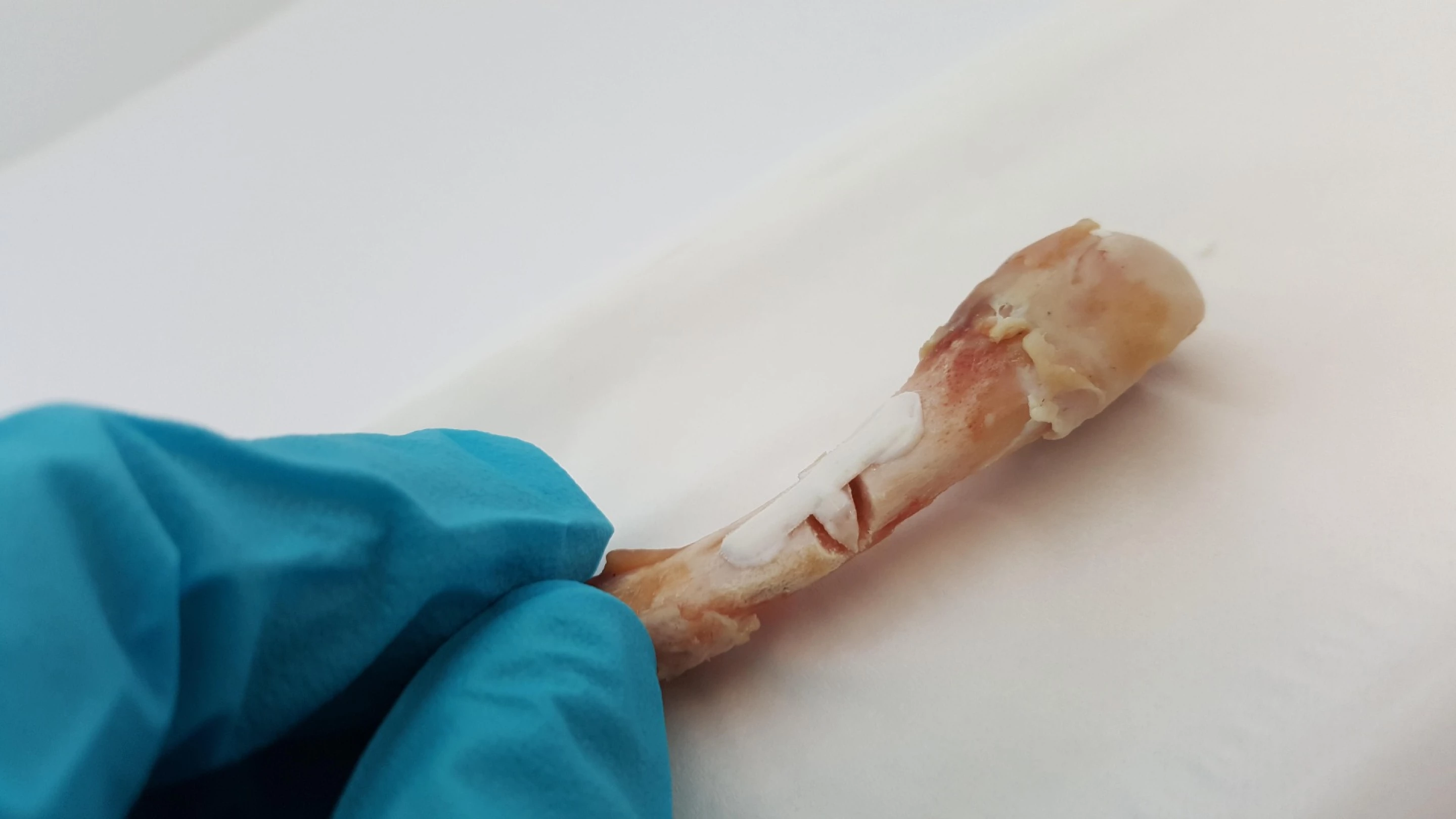 Light-cured bone patch may replace plates and screws