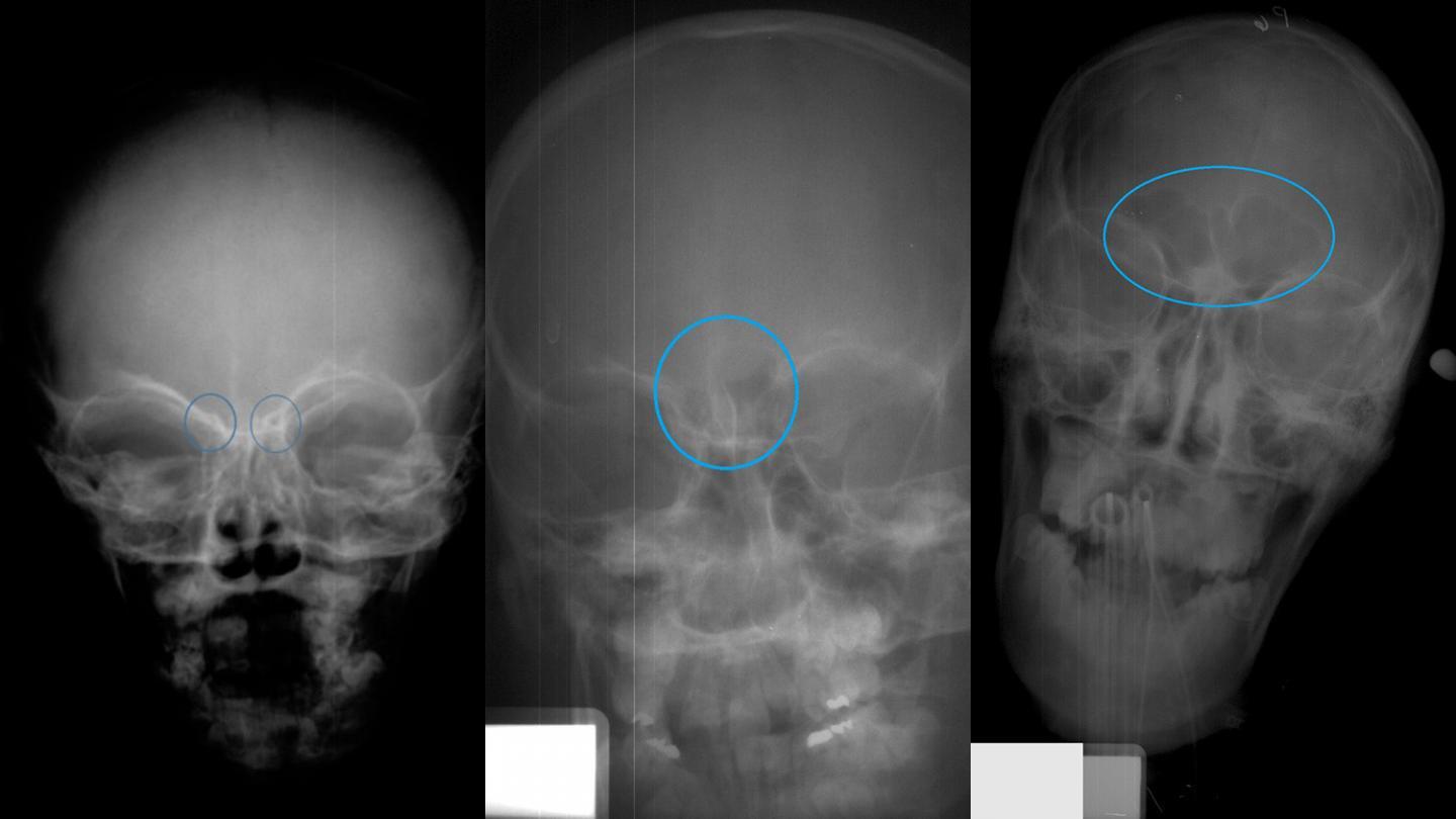Sinus X-rays reveal age of children