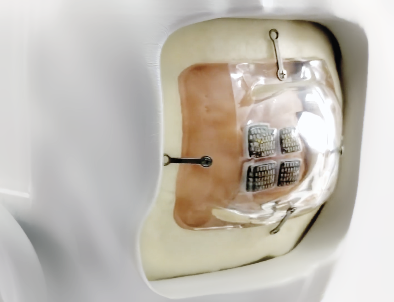 World First Bionic Vision System Poised For Human Trials 