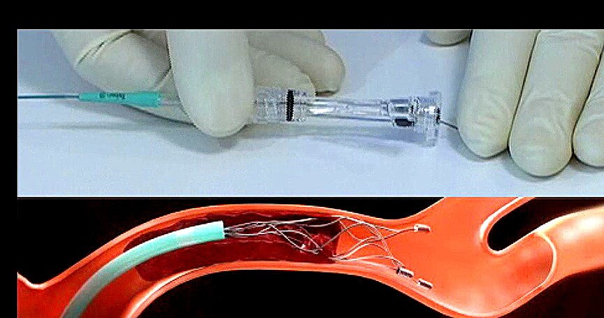 New device is more effective and safer than FDA-approved treatment for acute stroke patients