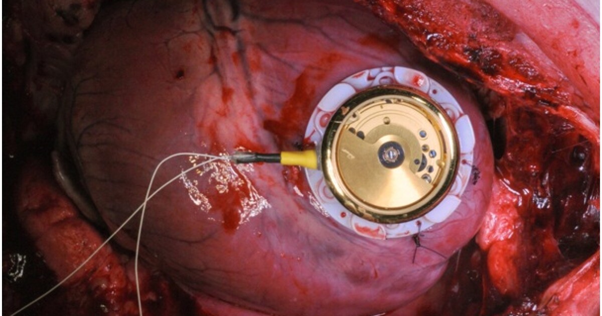 using power tools with a pacemaker