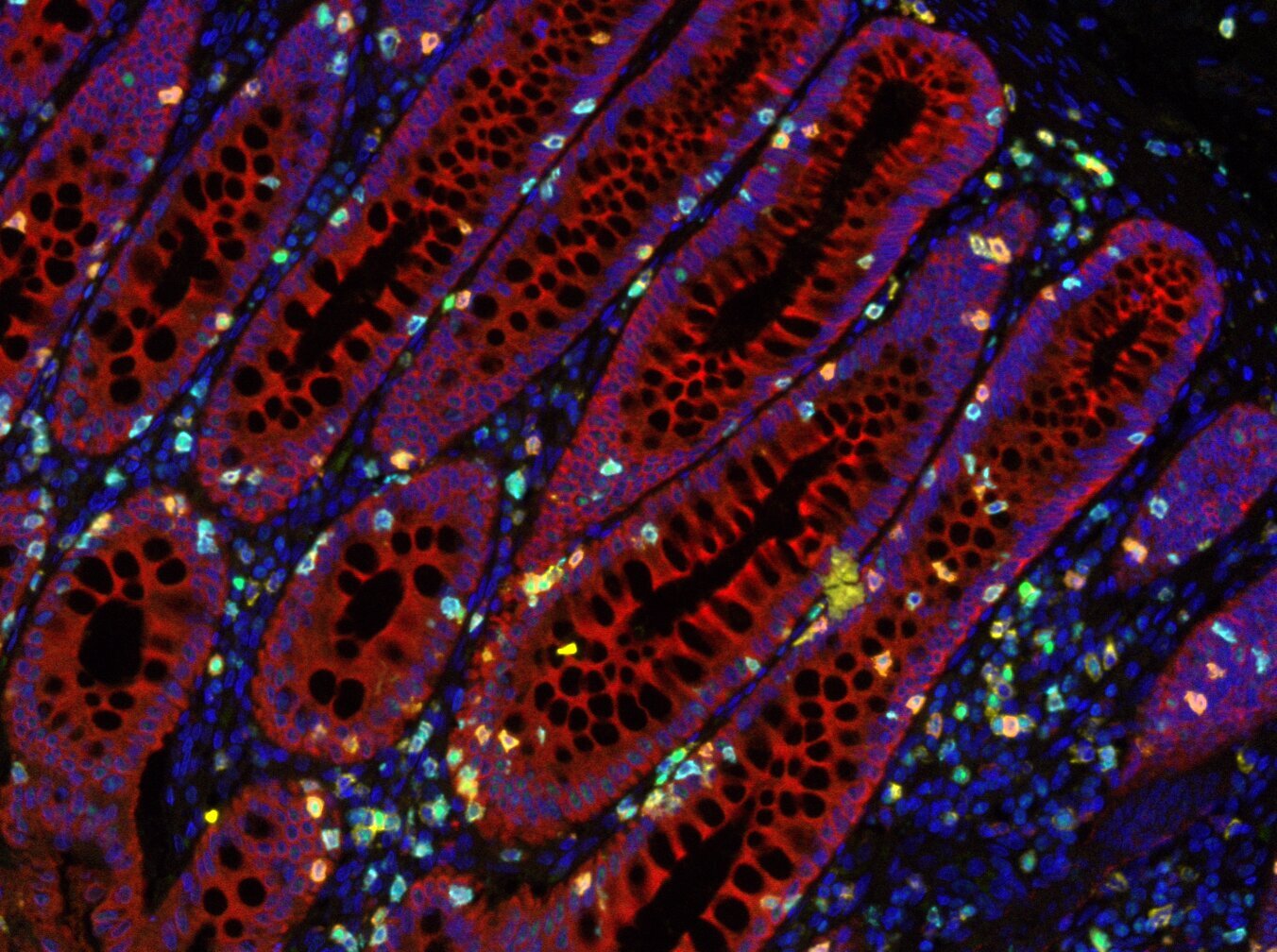 In A World First Scientists Discover Roadmap To Beating Bowel Cancer