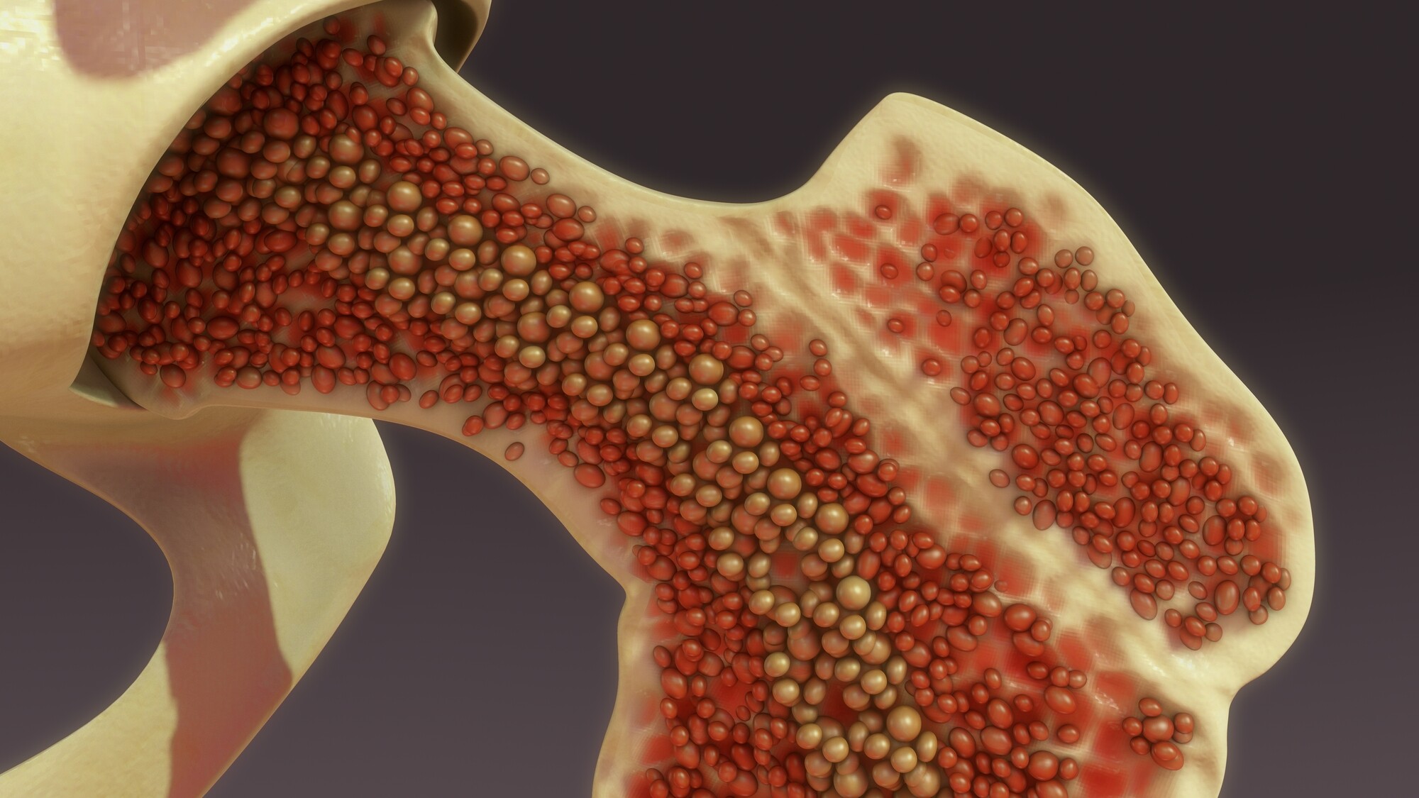 Chemotherapy Free Stem Cell Transplant Promises Safer Leukemia Treatment