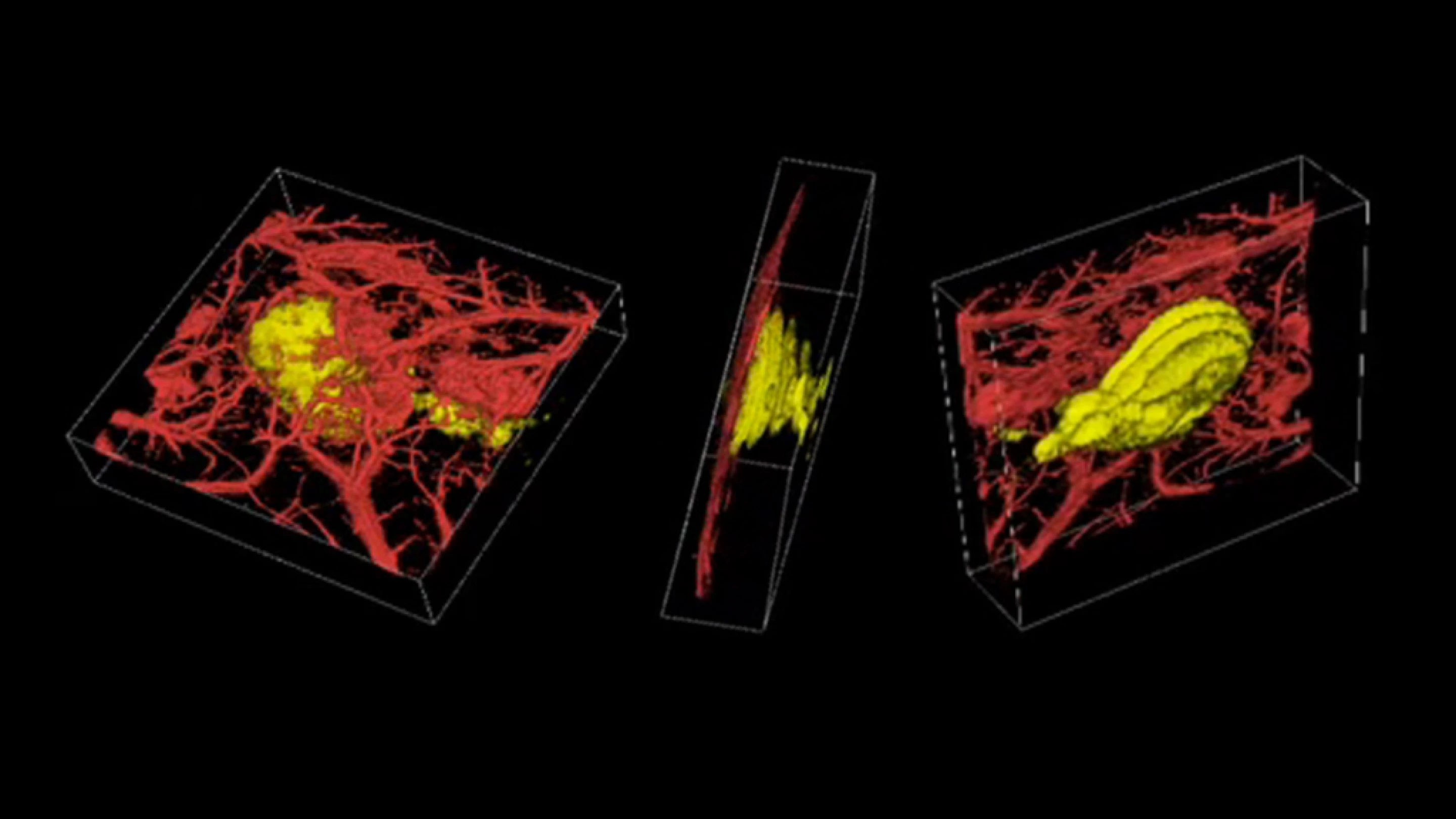 3D imaging technique provides clearer roadmap to remove deadliest form ...