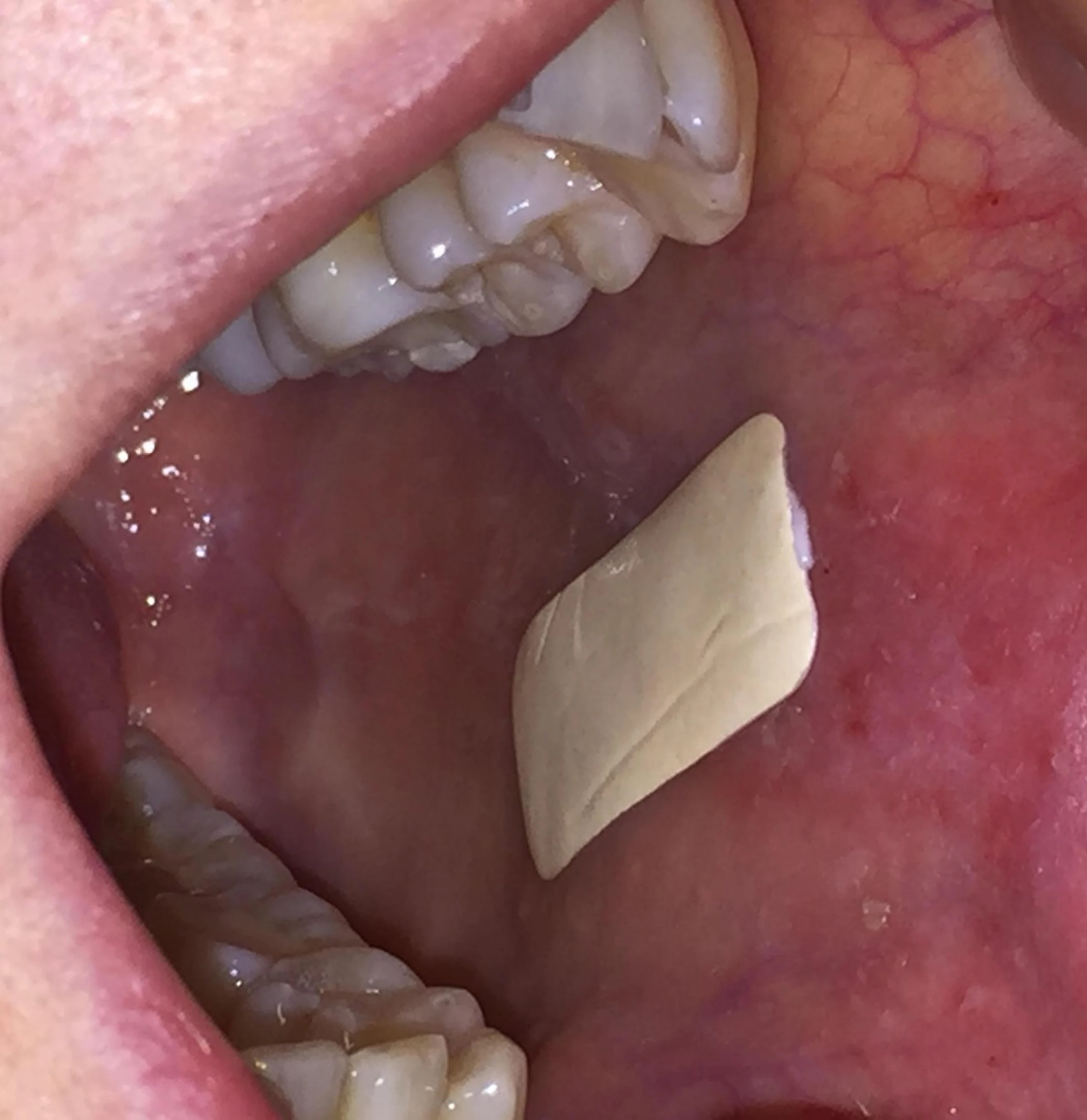 Drug-dispensing "mouth bandage" sticks it to sores