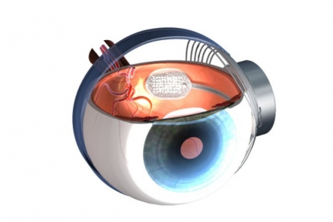 Second Sight announces milestone in groundbreaking retinal implant trial