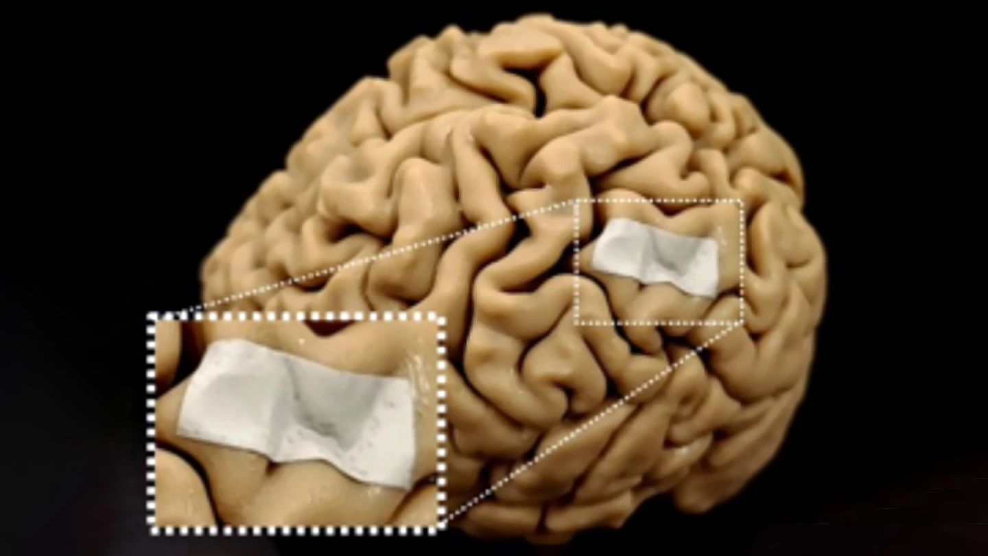 'Bio-paper' implant: Personalized wireless electrotherapy for Parkinson's