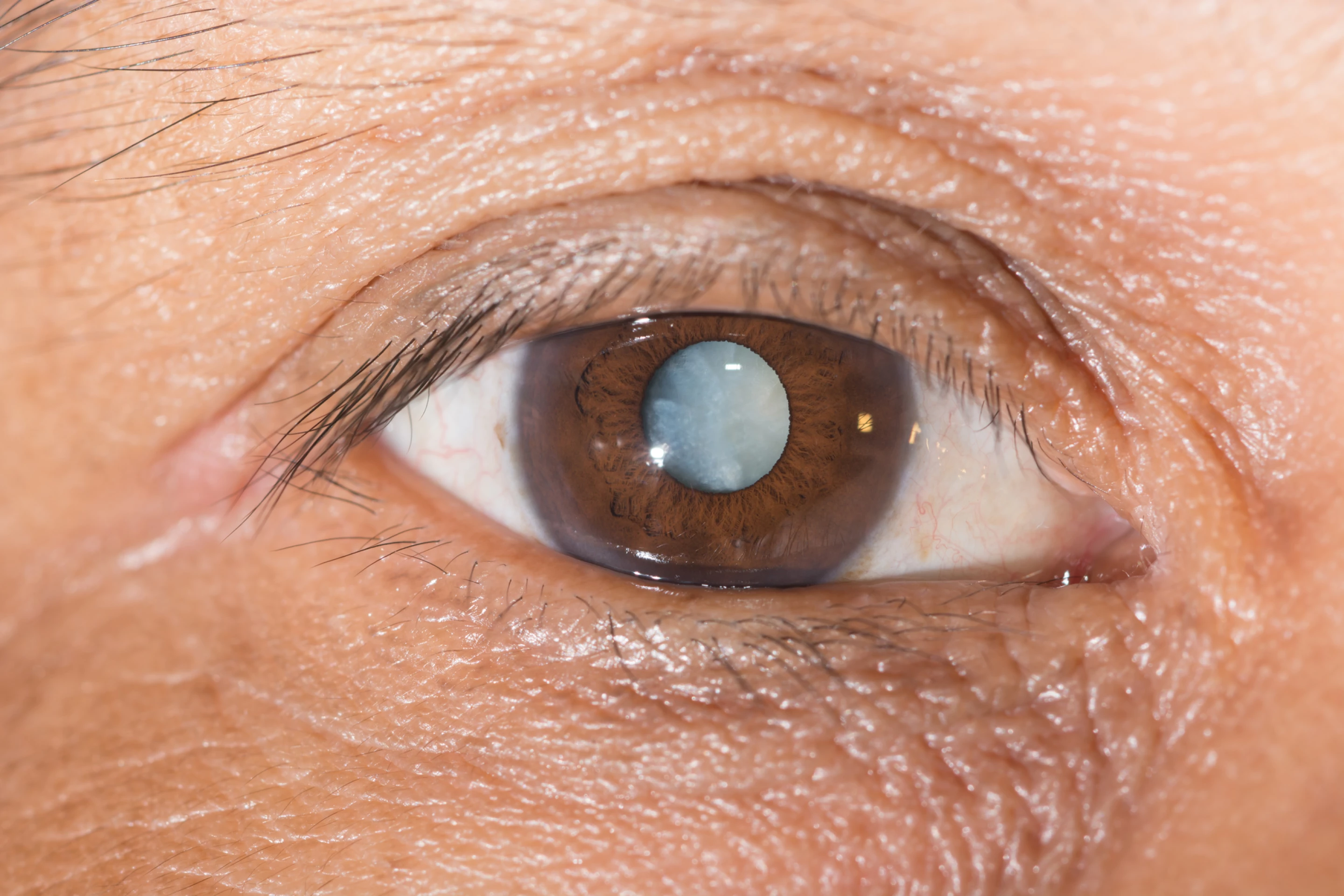 New cataract-clearing drug shows promise in tests in mice