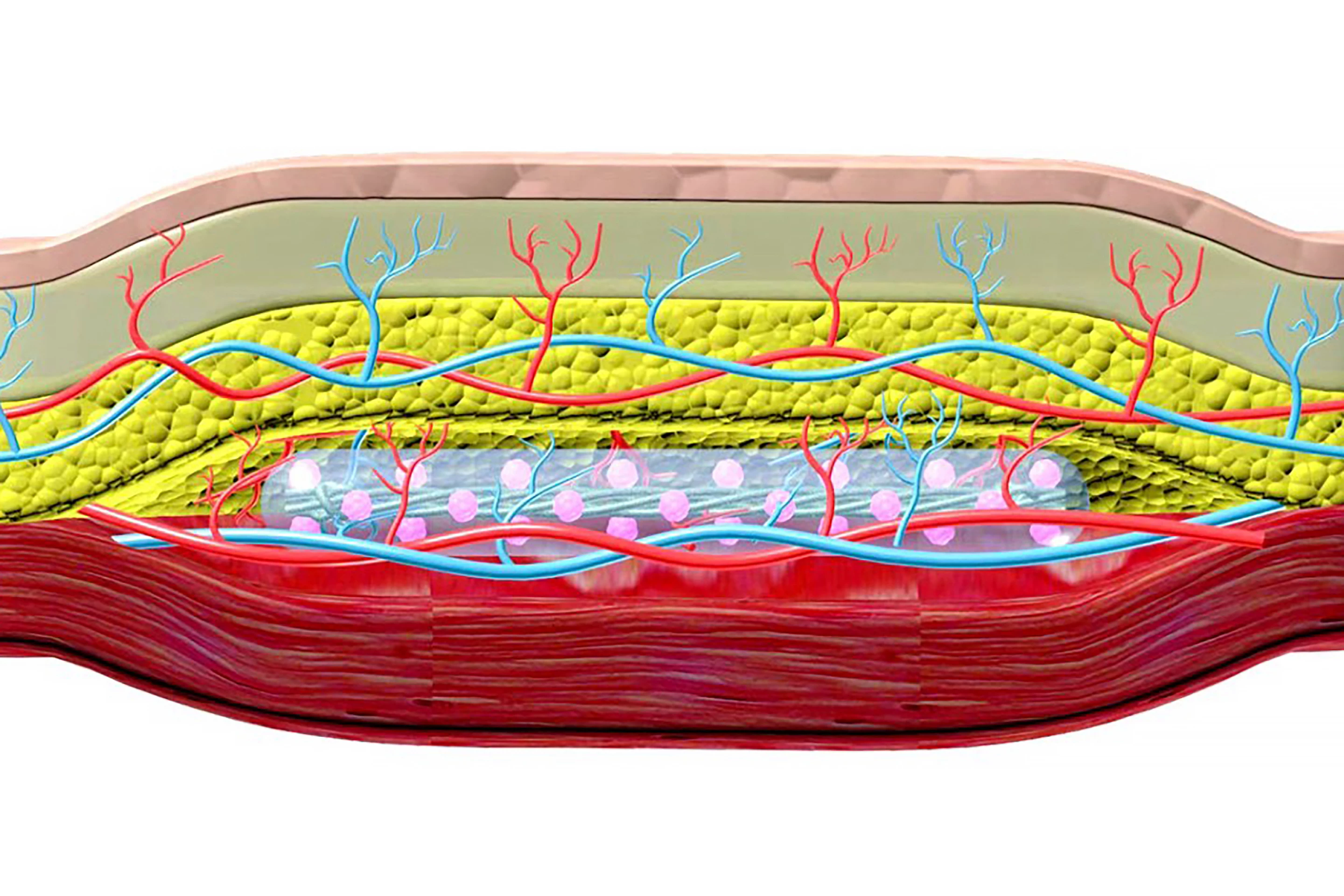 Under-skin implant reverses type 1 diabetes without anti-rejection drugs