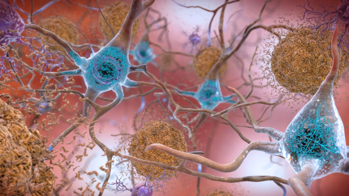 Alzheimer's scientists uncover "seeding" process of toxic protein tangles