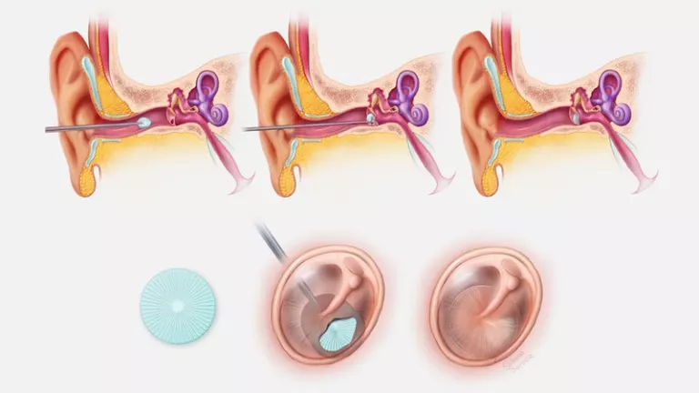 Harvard's 3D-printed eardrum repair patch is ready for market