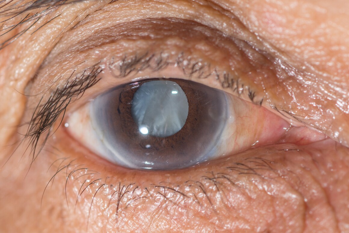 In-eye sensor to keep a watch on changes in intraocular pressure