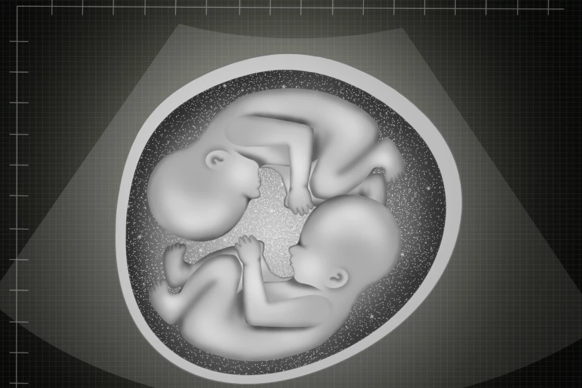 Incredibly rare "semi-identical" twins born in Australia