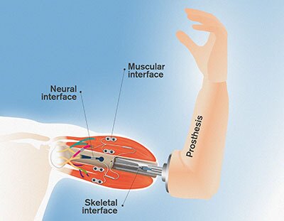 Mind-controlled prosthetic arms "feel" like the real thing