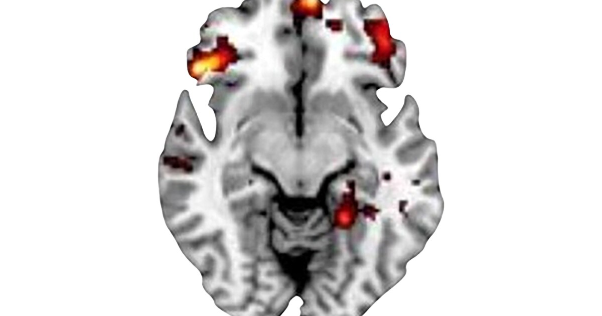 MRI scans reveal OCD alters the brain’s decision-making mechanisms