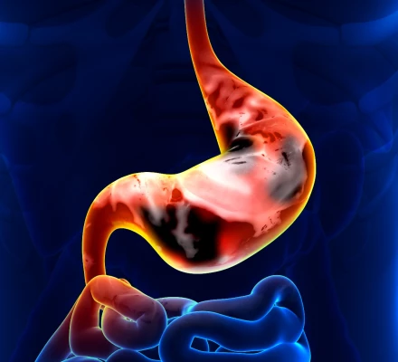 Breath test for stomach and esophageal cancers shows promise
