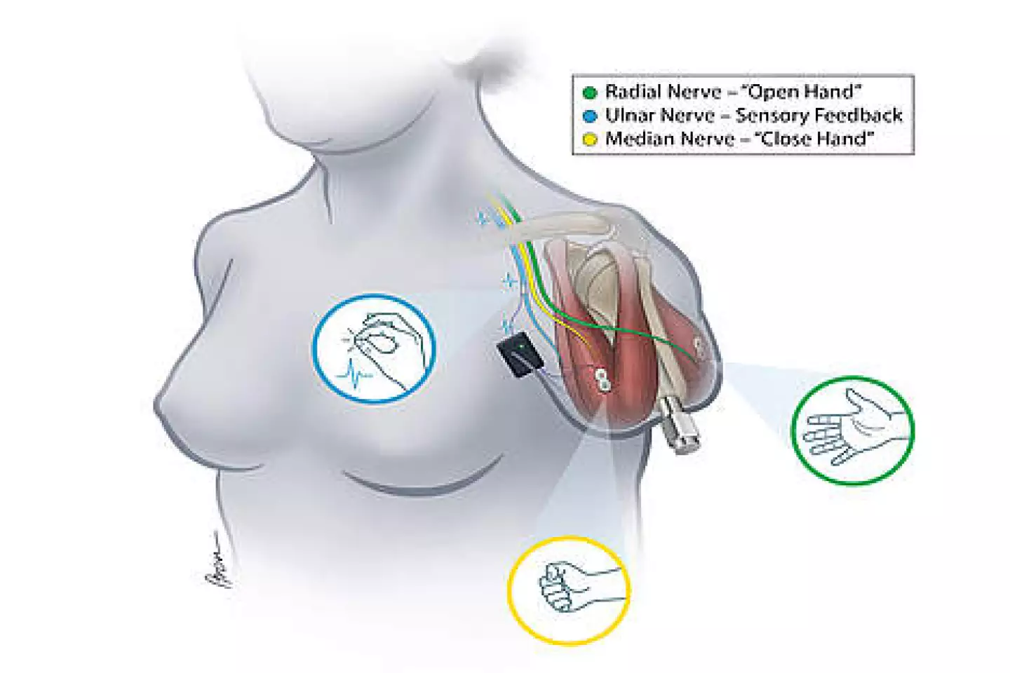 Mind-controlled prosthetic arms "feel" like the real thing