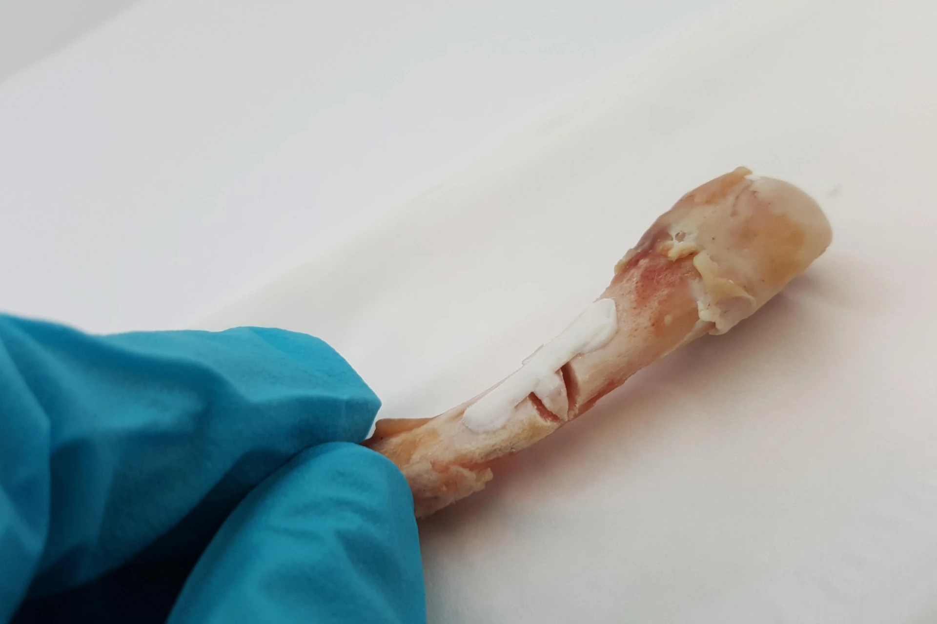 Light-cured bone patch may replace plates and screws