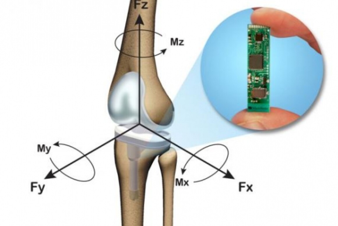 Wireless sensors measure 3D force and torque data in human knee replacement