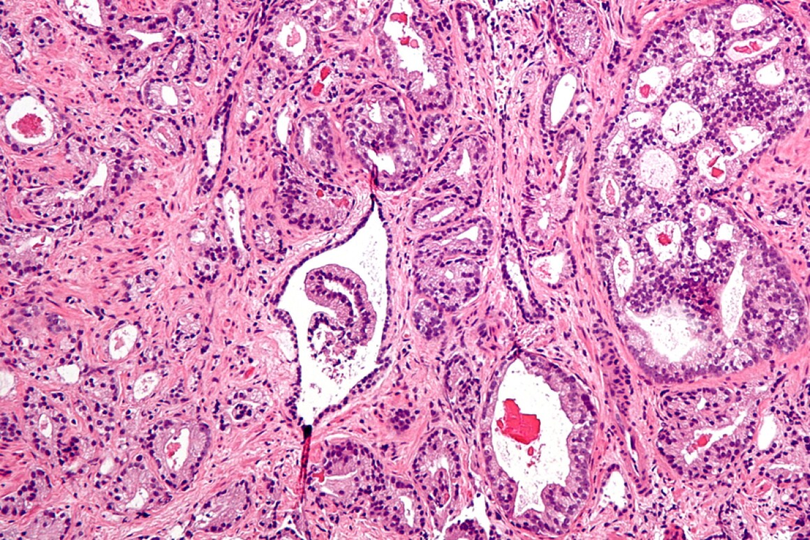 New ‘gene therapy’ vaccine approach gives hope in fight against cancer