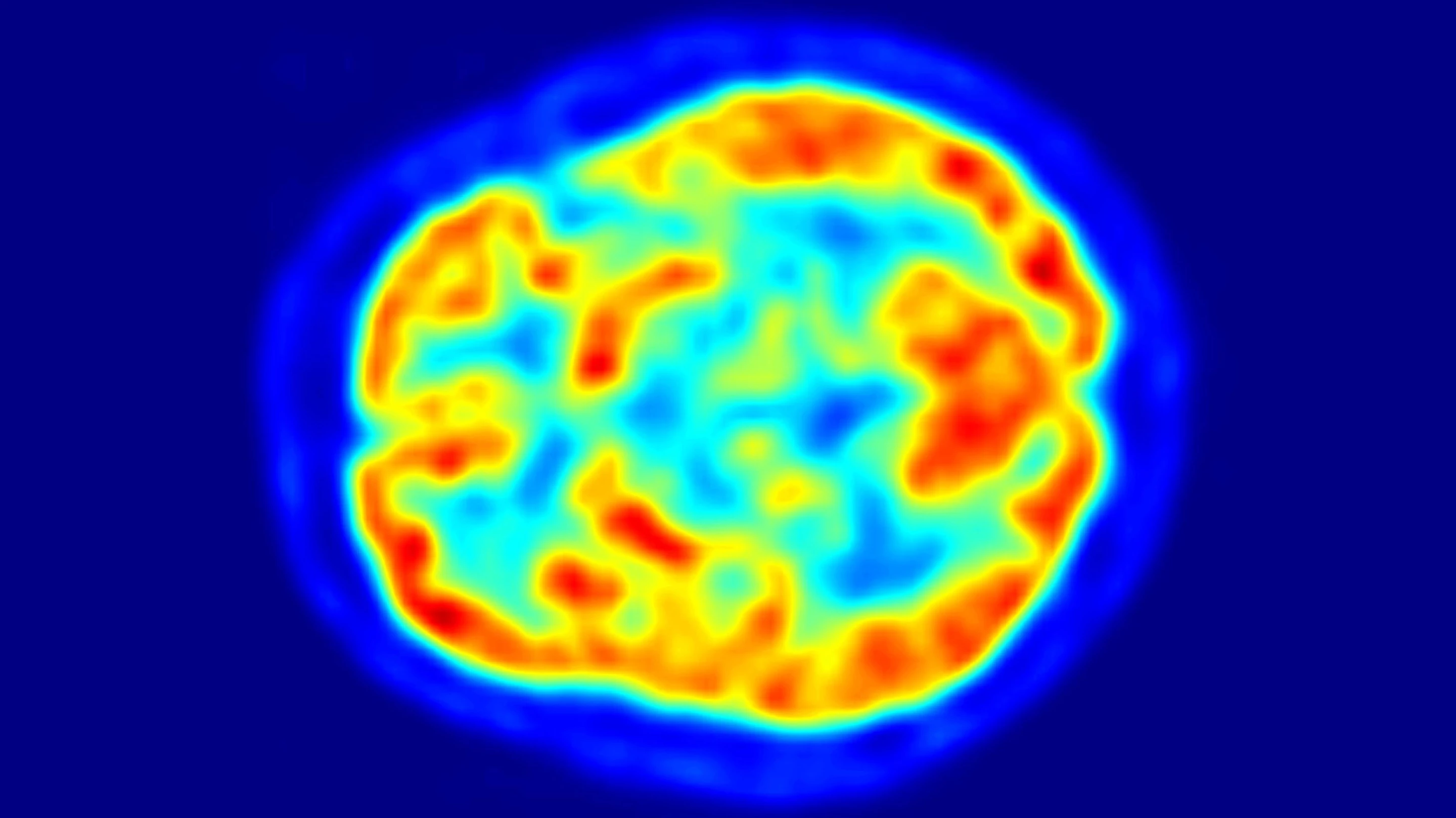 Deep learning algorithm detects Alzheimer’s up to six years before doctors