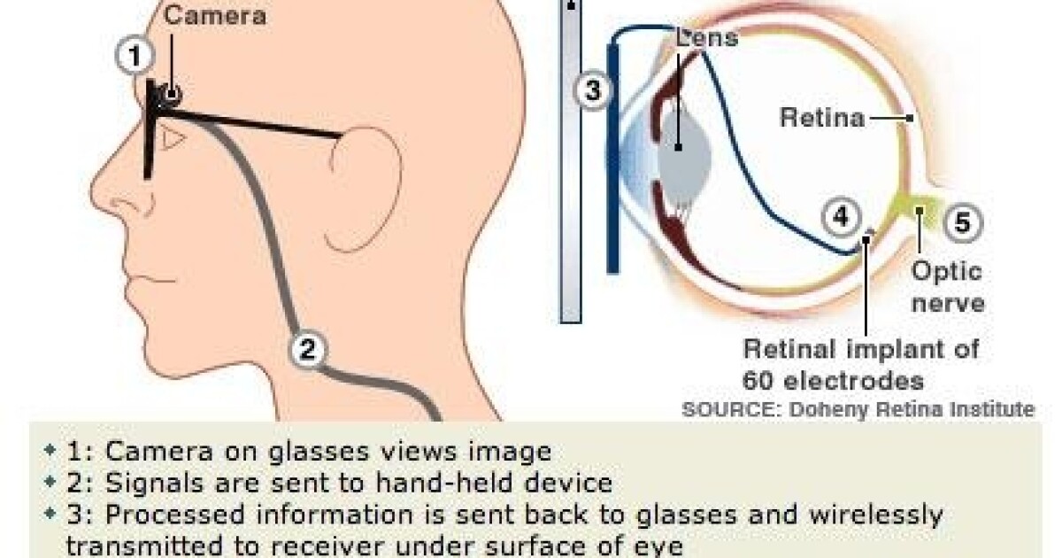 bionic eye implant