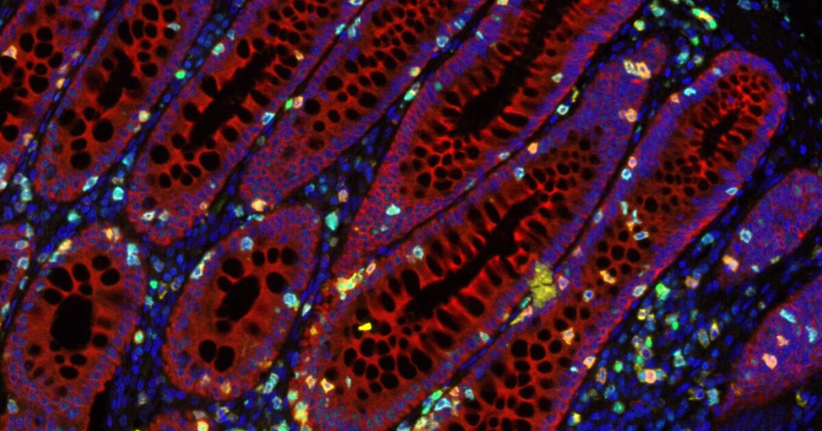 In A World First Scientists Discover Roadmap To Beating Bowel Cancer
