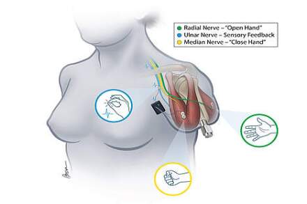 Mind-controlled prosthetic arms "feel" like the real thing