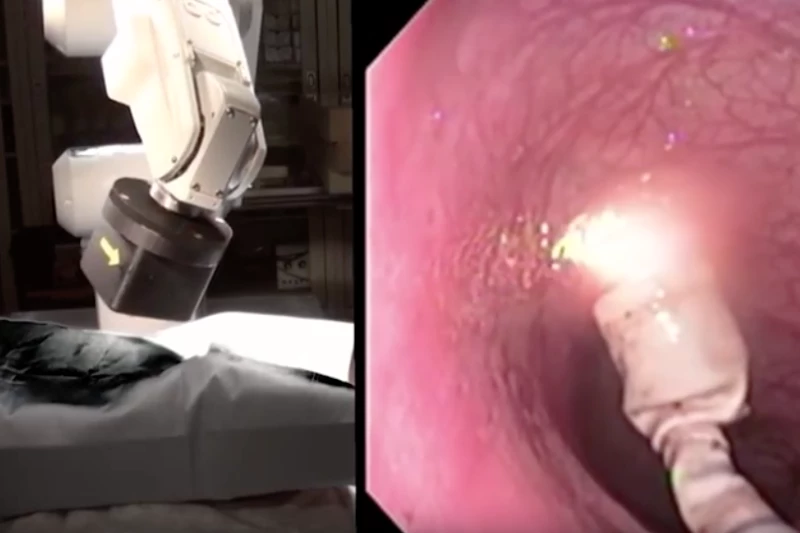 Colonoscopy performed by magnetically controlled capsule robot
