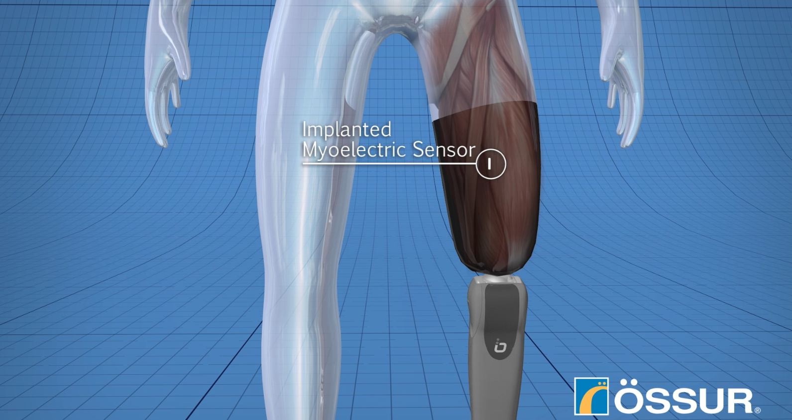 Breakthrough bionic leg prosthesis controlled by subconscious thoughts