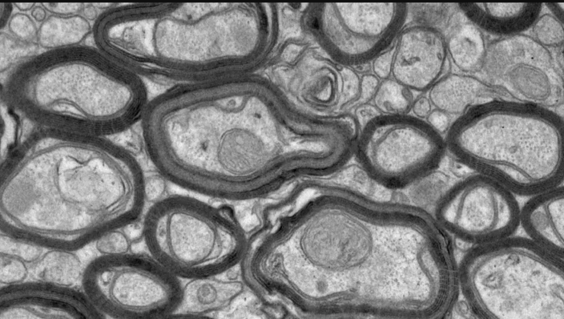 Synthetic peptide helps repair myelin damaged by MS